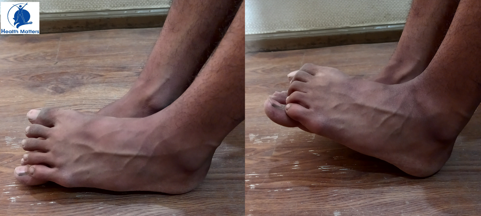 Foot Drop - Physiotherapy for Foot Drop