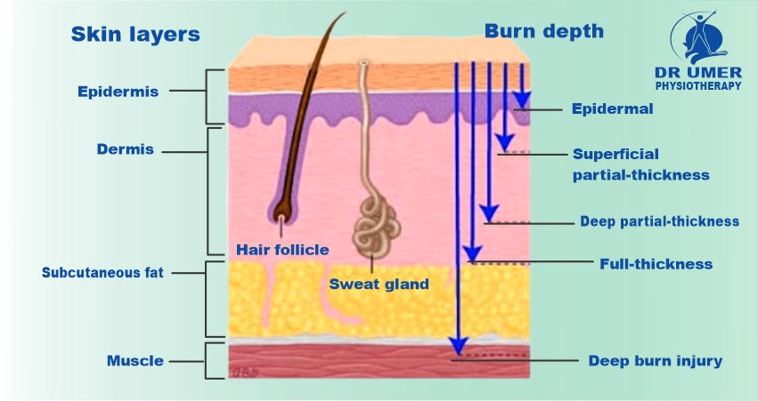 Physiotherapy Management of Burn